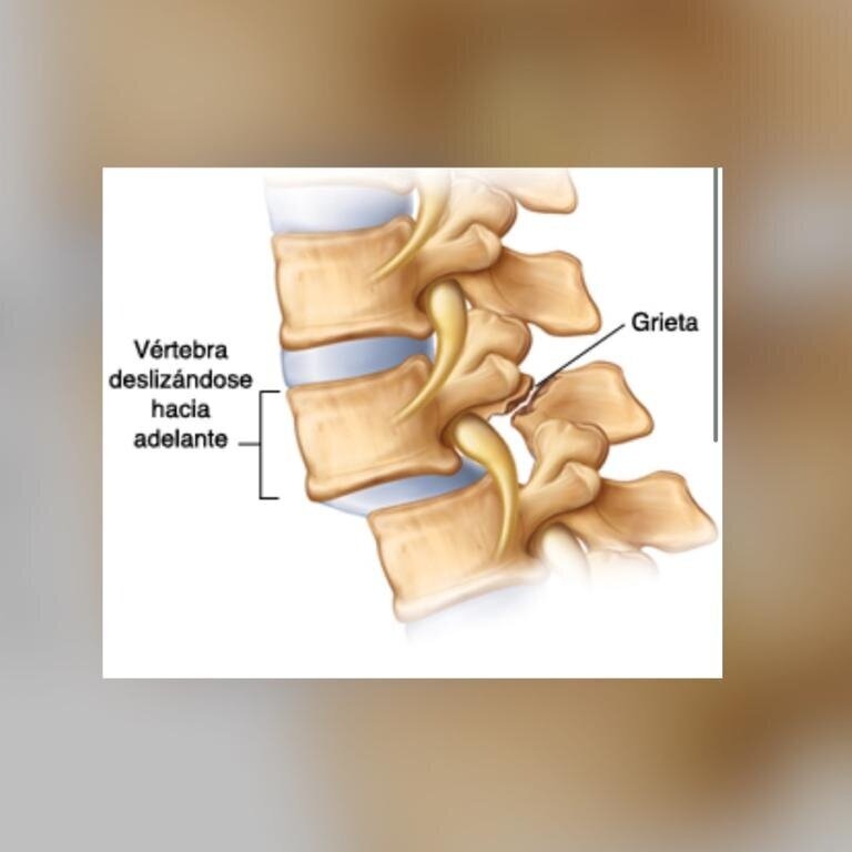 Espondilolistesis - Dr. Juan Héctor Correa